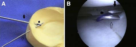 Outside In Singlelasso Loop Technique For Meniscal Repair Fast