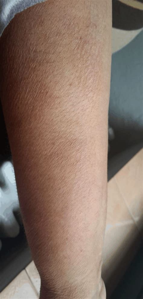 Large Plaque Parapsoriasis Wrinkled Forearm With Tissue Paper