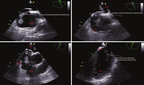 Transesophageal Echography Showing A Thrombus A Straddling The Patent Download Scientific