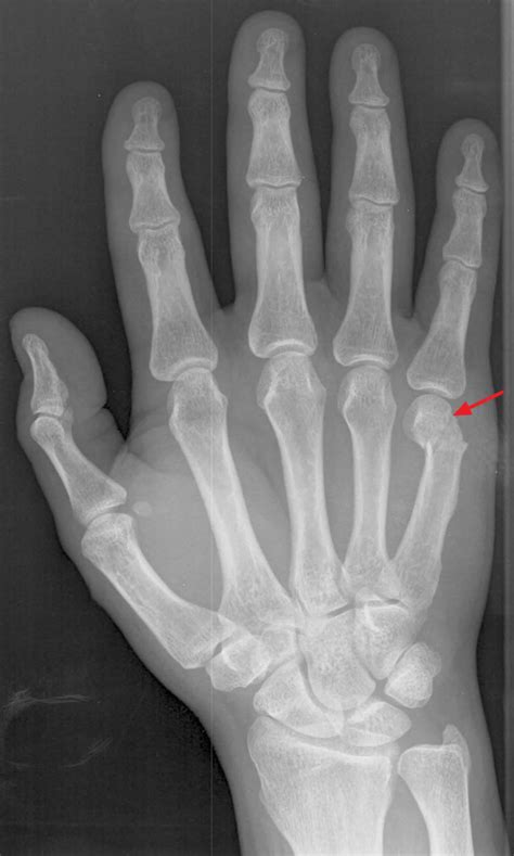 Metacarpal Fracture Causes Symptoms Diagnosis And Treatment