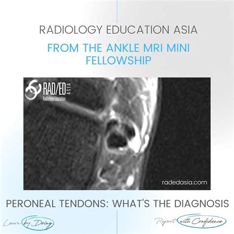 Brevis Tendon My Xxx Hot Girl