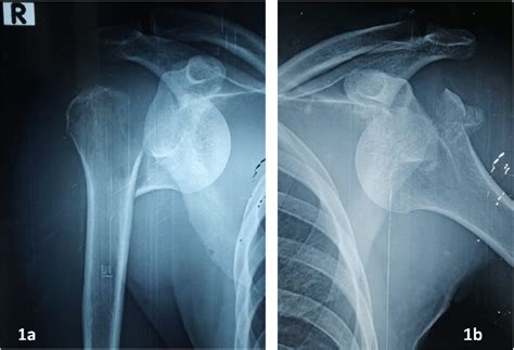 Shows Fracture Dislocation Of Bilateral Shoulder Joints With A Two Part
