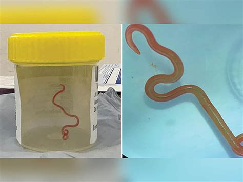 How A Parasitic Worm Got Into An Australian Womans Brain The