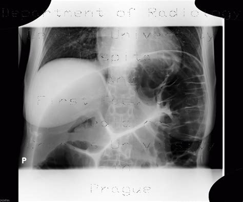 Radiology Case Sigmoid Volvulus Ileus