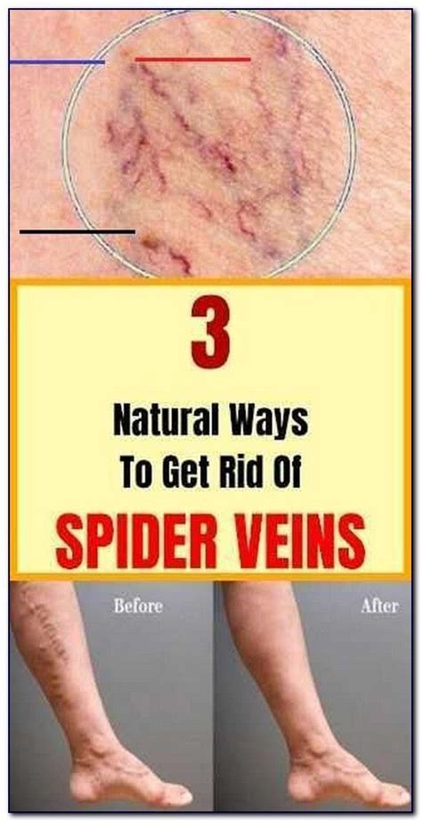How To Get Rid Of Spider Veins On Your Legs Face Feet Artofit