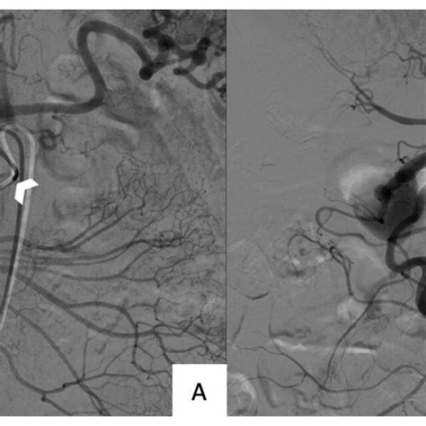 Angiogram Of The Superior Mesenteric Artery During Transarterial