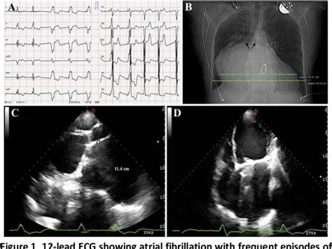 Figure 1 From An Unusual Case Of Severe Myocardial Dysfunction In A