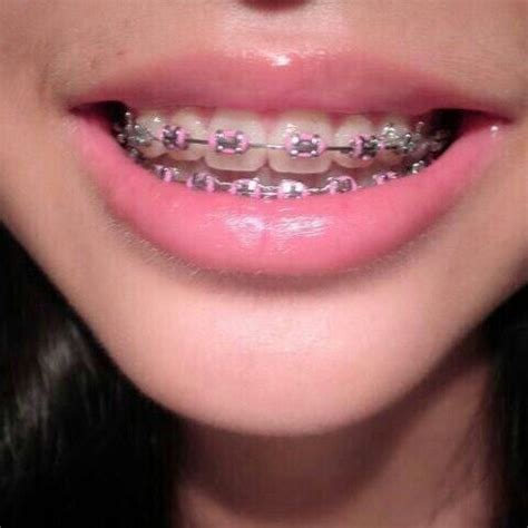 Пин от пользователя Delossantosc на доске Braces Зубные брекеты Брекеты Здоровые зубы