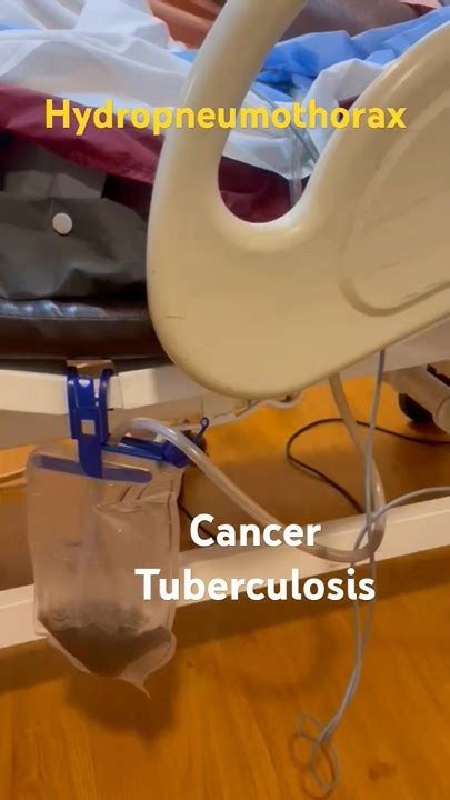 Hydropneumothorax Pleural Fluid Fluid In Lungs Shorts Shortvideo
