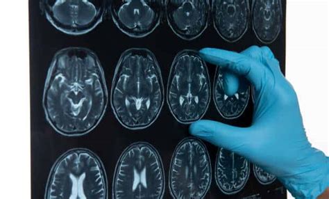 Neurovascular Assessment Clinical Guide Sample Chart And Pdf Makedailyprofit