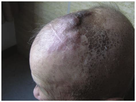 Recurrence Of The Scalp Angiosarcoma Download Scientific Diagram