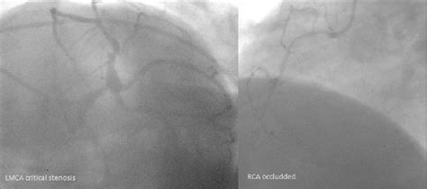 Coronary Angiogram Of The Same Patient Ccs Class Ii Angina A