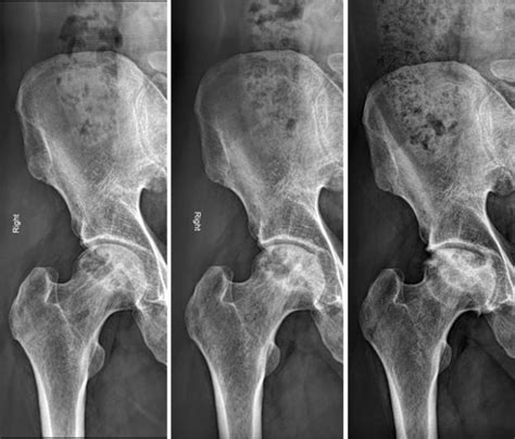 Osteonecrosis Of Femoral Head Femoral Head Osteonecrosis Avascular
