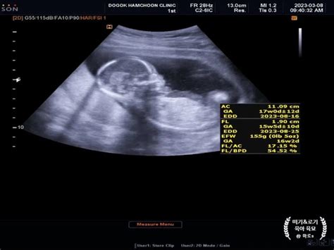 임신 16~20주차 성별 확인 신경관 결손 정밀 초음파 검사 네이버 블로그