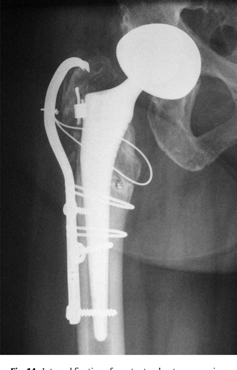 Figure 14 From Surgical Management Of Recurrent Dislocation After Total