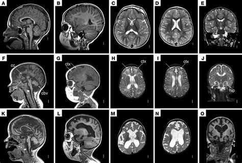 Abnormal Brain Mri