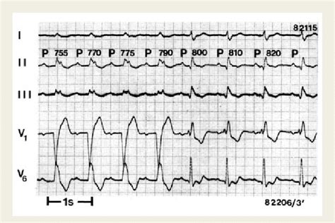 Bilateral Bundle Branch Block During Sinus Rhythm A Left Bundle Branch Download Scientific