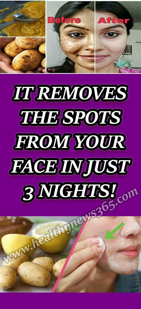 IT REMOVES THE SPOTS FROM YOUR FACE IN JUST 3 NIGHTS HEALTH ROOTS