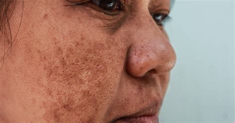 Hyperpigmentation On The Forehead Know The Causes And The Solution