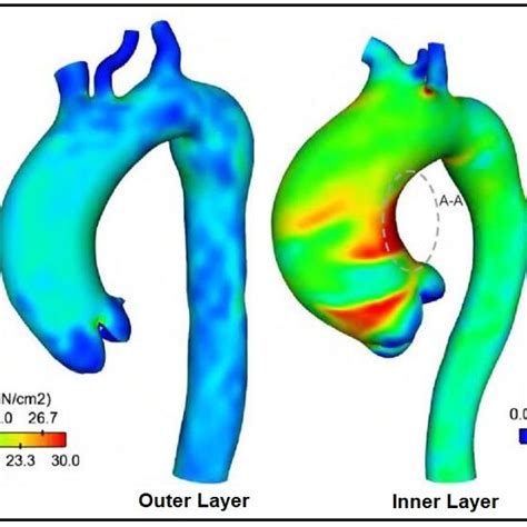 Computational Fsi Analysis For Inner And Outer Maximum Wps In Ataa