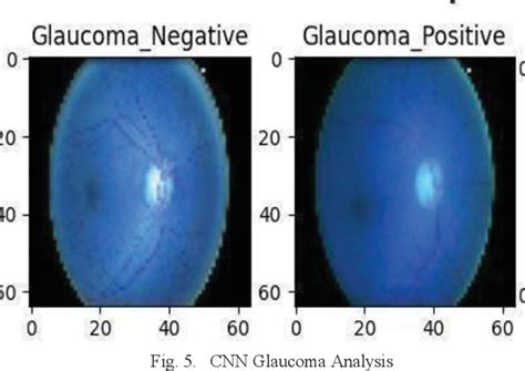 Figure 1 From Enhancing Glaucoma Diagnosis Through Image Processing And Supervised Learning