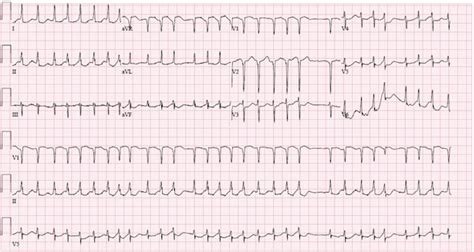 Afib With Rvr Treatment