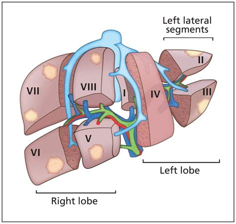 Two Stage Hepatectomy For Liver Metastasis From Colorectal Cancer Cmaj