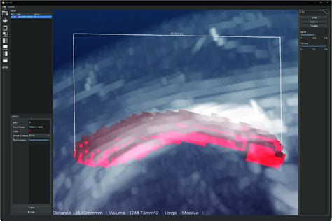 Three Dimensional Visualization Of The Rotator Cuff Tear Region The