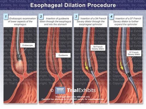 Esophageal Dilation Procedure Trialquest Inc