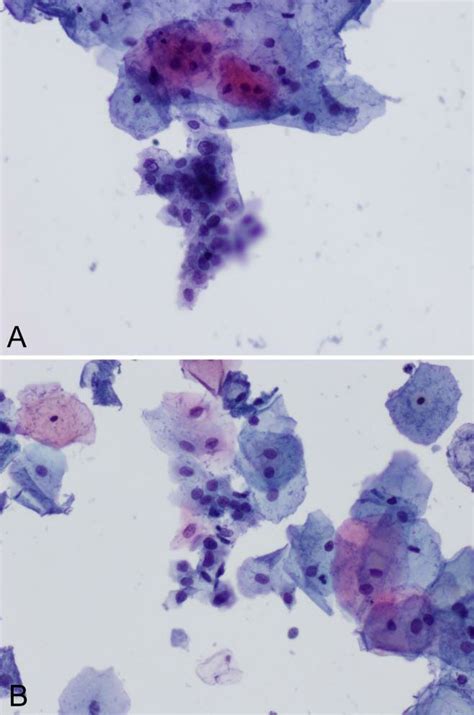 Liquid Based Cytology Thinprep Papanicolaou Stain 440x A And B