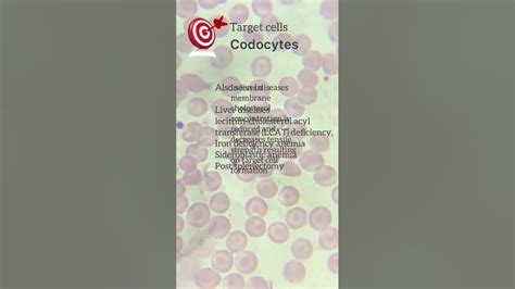 Codocytes Target Cells Ilovepathology Pathology Hemepath Youtube