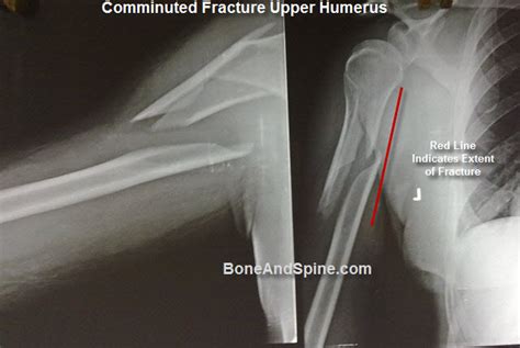 Xrays Of Fracture Of Humerus Bone And Spine