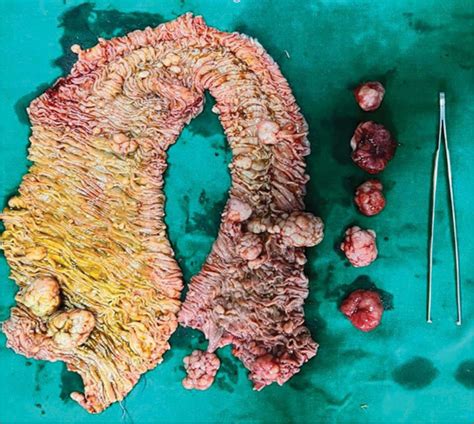 A Case Of Peutz Jeghers Syndrome Presenting As Multiple Intussusception