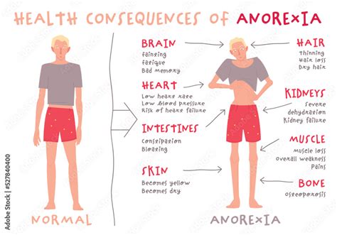 Eating Disorder In Men And Boys Anorexia Nervosa Stock Vector Adobe