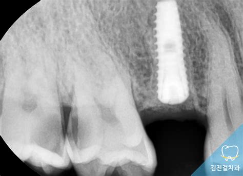 [발치 즉시 임플란트 수술] 윗니 작은 어금니 판교 임플란트