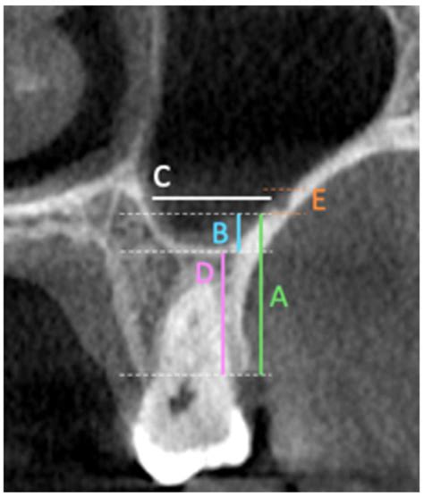 Posterior Superior Alveolar Artery Gingival Branch Extraosseous