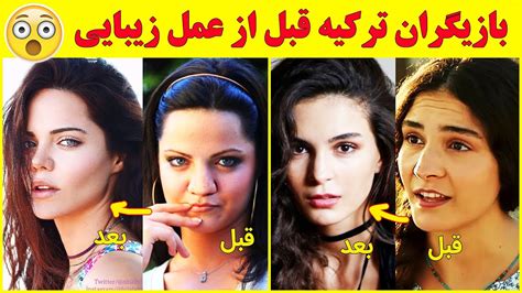 بازیگران ترکیه قبل و بعد از عمل زیبایی 😮 بازیگران ترکی که عمل زیبایی