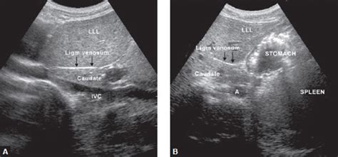 Falciform Ligament Ultrasound