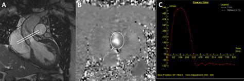 Velocity Encoded Phase Contrast Imaging A With Respect To The