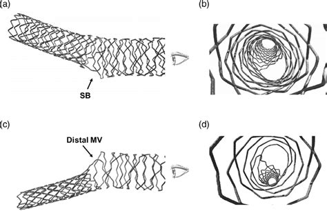 Micro Ct Image Of Stent Deformation Obtained By Provisional And