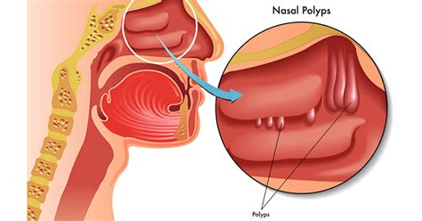 Nose Ethmoidal Polyps Dr Meenesh Juvekar Ent Specialist