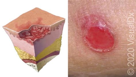 Pressure Ulcer Staging Quiz