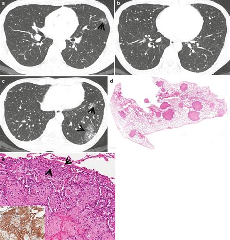 Multiple Nodular Or Mass Like Pattern Radiology Key Multiple Nodular Or Mass Like Pattern Radiology Key