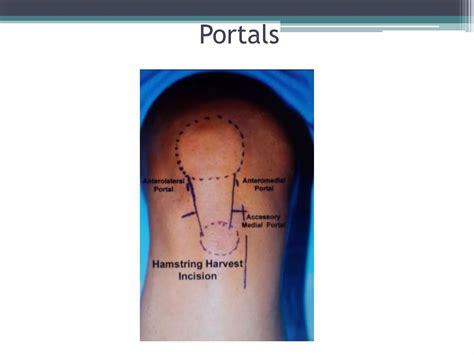 Acl Reconstruction Quadrapled Hamstring Graft Pptx