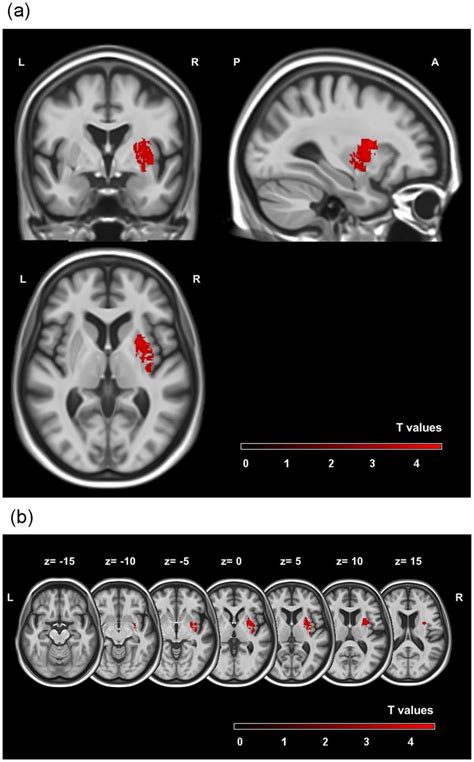 significant cluster 1 of the voxel based lesion symptom mapping