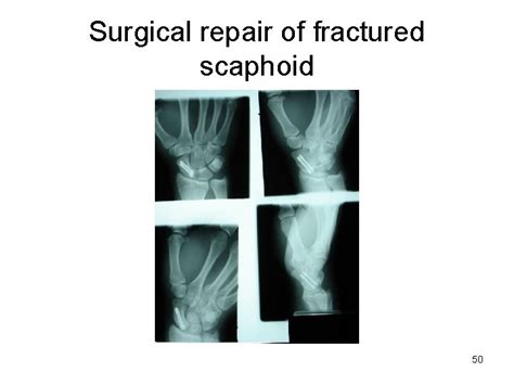 Basics Of Hand Finger Radiography Routine Views For