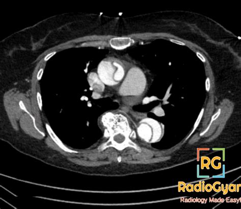 Aortic Dissection Radiology Reference Article Radiogyan
