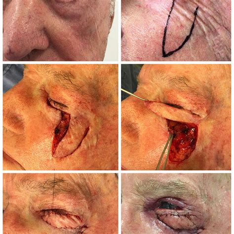 Technique Sequence Of The Zygomatic Palpebral Flap Procedure Used For