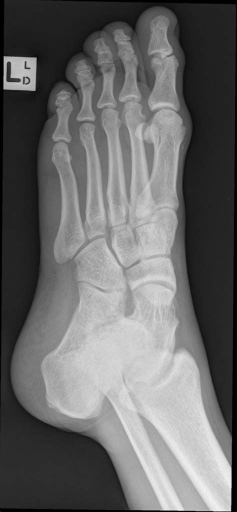 Foot Xray Anatomy