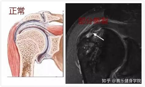 肩周炎、肩峰撞击综合症、肩袖损伤傻傻分不清（1） 知乎